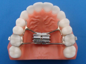 Phase I Interceptive Orthodontics | Fairfield Dentistry and Implant ...